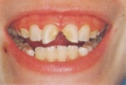 6. Hambatraumad – Suuõõne haigused ja nende ennetamine