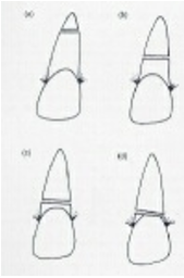 6. Hambatraumad – Suuõõne haigused ja nende ennetamine