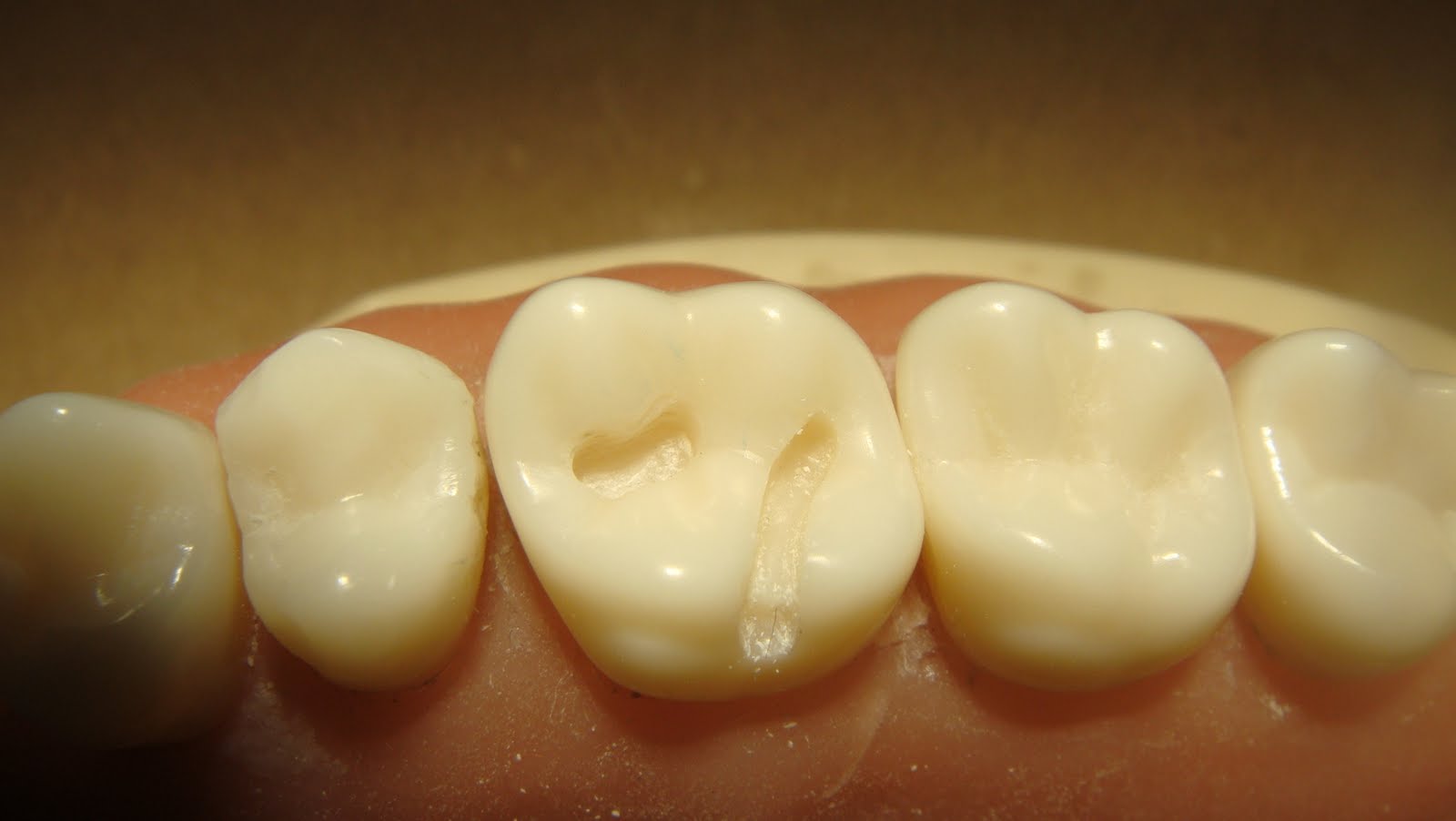 2.4.3. Bukaalsesse või palatinaalsesse fissuuri ulatuv kaviteet ...