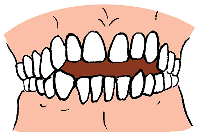 Hambumusanomaaliad – Hambaarst märkab hambumusanomaaliat