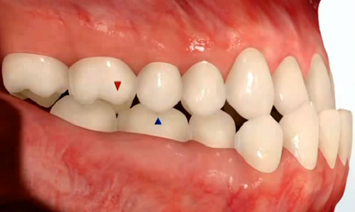 Test: hambakaared ja hambumus – Hammaste anatoomia ja oklusioon