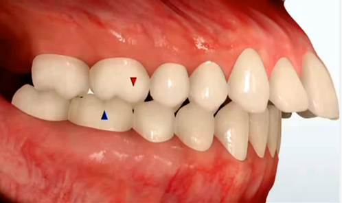 Test: hambakaared ja hambumus – Hammaste anatoomia ja oklusioon